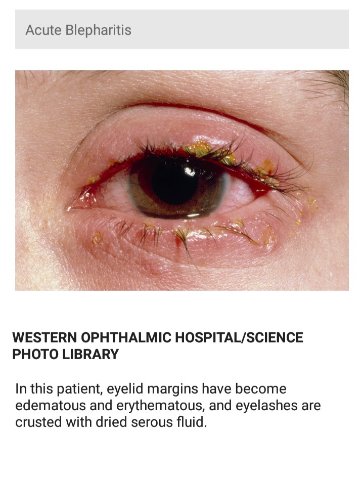 Buy Blepharitis by Dr.famous Williams. on Selar