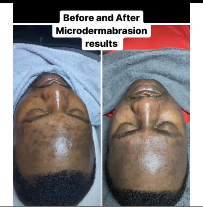 Buy Microdermabrasion by Massageenvy aesthetics on Selar