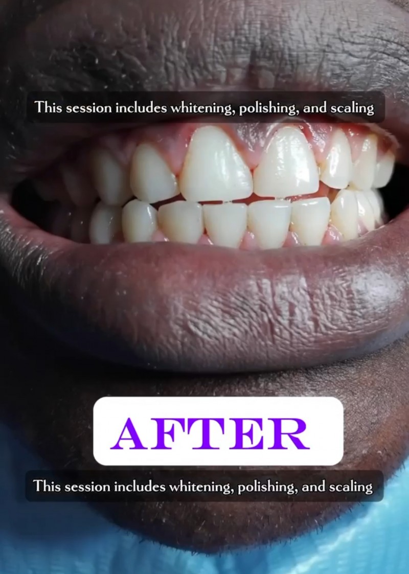 Buy Triple oral service (teeth whitening, scaling and polishing) by ...