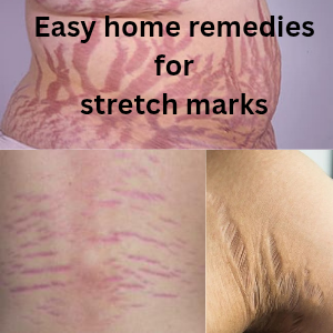 Buy Easy home remedies for stretch marks by Favour Onuoha on Selar